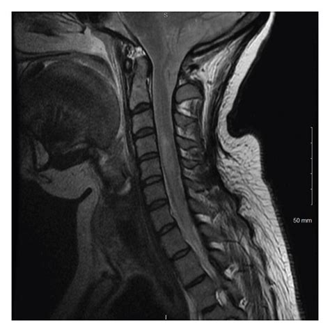 Mri C Spine Sagittal T2 Sequence Download Scientific Diagram
