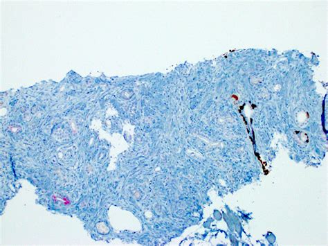 Pathology Outlines Atrophic Adenocarcinoma