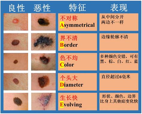 这3个部位的痣易癌变如果出现这5种情况请尽早就医 澎湃号湃客 澎湃新闻 The Paper