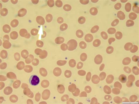 Reticulocytosis Pearls4peers