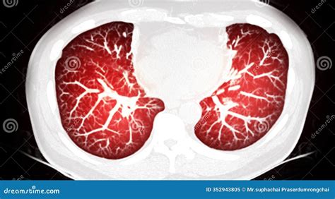 Ct Chest Scan Overview Shows Clear Lung Fields Heart And Mediastinum Providing A Detailed