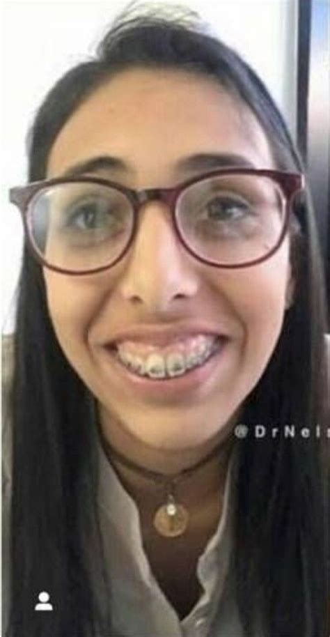 치아교정 전 후 인상변화