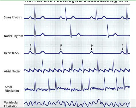 Solved What Is Visually Different In The Ecg Reading From