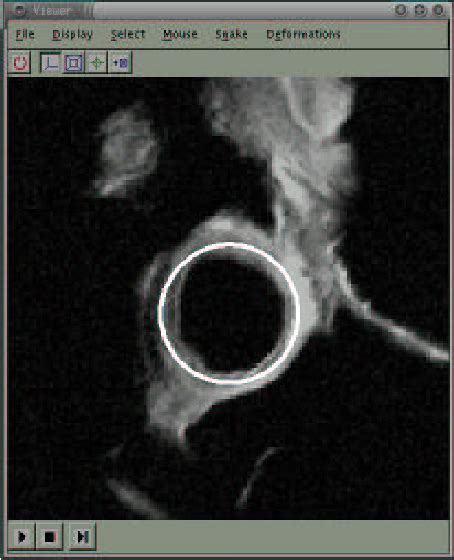 Deformable Contour Object Overlaid On A Carotid Mri Slice The Data Are Download Scientific