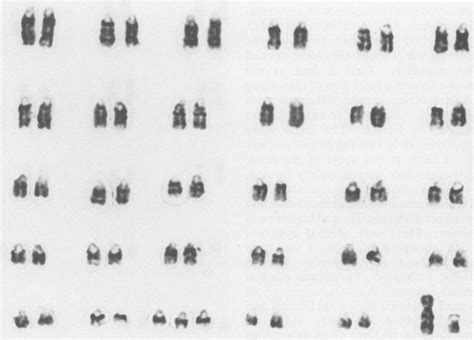 Karyotype Of Trisomic Case 1 61 Xy 27 Download Scientific Diagram