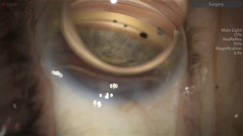 Istent Inject Youtube