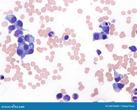 Hemophagocytosis By Plasma Cells In A Case Of Multiple Myeloma Stock