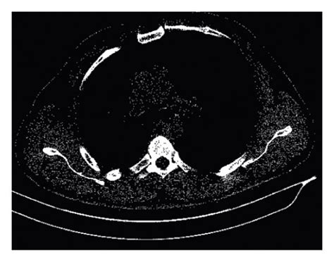 The Comparison Outcomes A Original Ct Image 3 Bd Segmentation