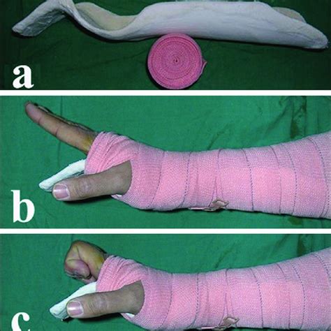 A The Splint B Combined IP And MCP Joint Extension Exercise C Download Scientific