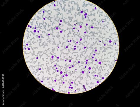 Microscopic Images Are Acquired From Blood Smears Of Patients With