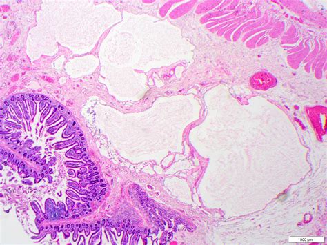 Multinodular Goiter Histology