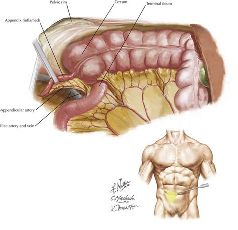 Sentinel Lymph Node Biopsy Basicmedical Key