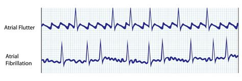 Atrial Fibrillation Vs Atrial Flutter