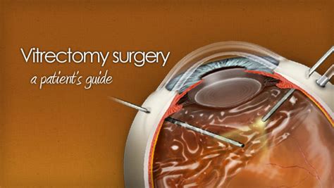 Vitrectomy Cpt Coding For Surgery In The Postop Period