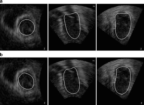 Constrained Marginal Space Learning Radiology Key