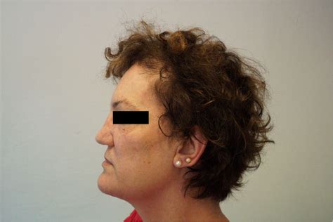 30 Facts About Hyperostosis Corticalis Generalisata