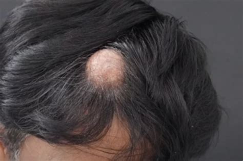 Sebaceous Cyst Excision On Scalp New Pimple Popping Videos