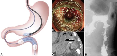 Novel Eus Guided Double Balloon Occluded Gastrojejunostomy Bypass Gastrointestinal Endoscopy
