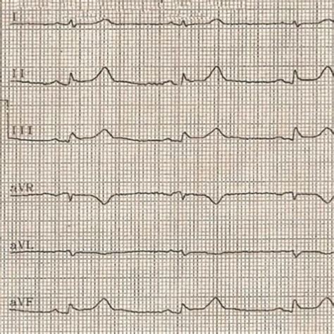 Case Report 2 ECG Of The DI DII DIII AVR AVL And AVF Derivation