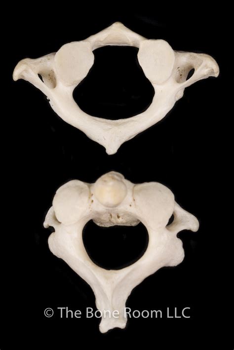 Atlas Vs Axis Bone Posterolateral View Of The Atlas C1 And Axis C2