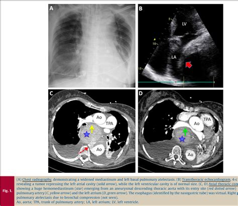 Figure 1 From An Unusual Cause Of Cardiogenic Shock Left Atrial Compression By A Spontaneous