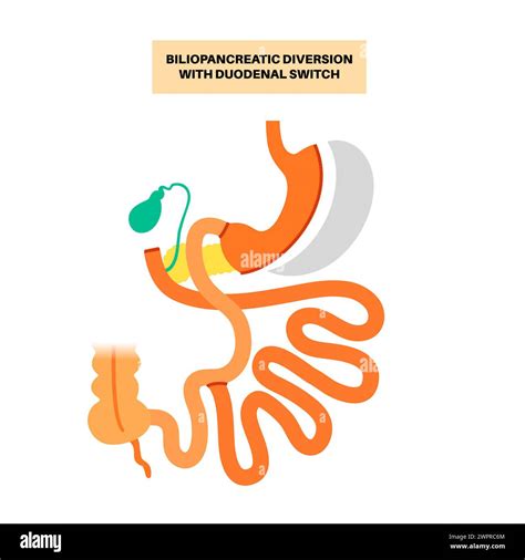 Biliopancreatic Diversion Bpd With Duodenal Switch Illustration