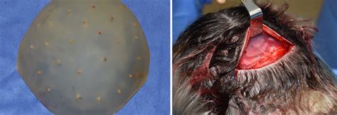 Plastic Surgery Case Study A Standard Preformed Skull Implant For Female Crown Augmentation