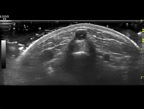 Ganglion Cyst 1st Extensor Tendon Compartment Sonotool®