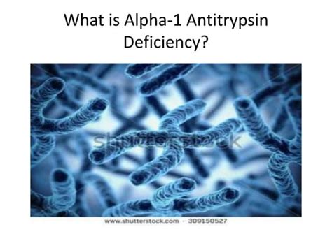 Alpha 1 Antitrypsin Deficiency Pptx
