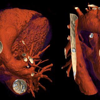 Threedimensional Reconstruction Of The Heart Based On The Computed Download Scientific Diagram