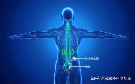 骶神经调控治疗效果适应症选择及电极精准植入 知乎