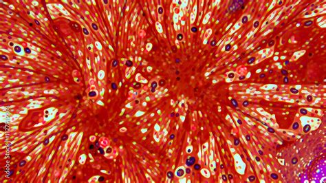 Radial Scar Of Breast Is A Benign Lesion That Can Mimic Cancer By Radiology And Histology