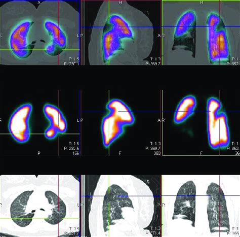 Perfusion Single Photon Emission Computed Tomography Computed Download Scientific Diagram