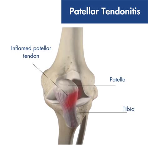 Patella Tendon Anatomy