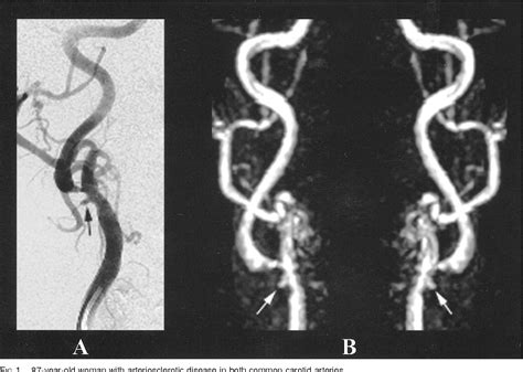 Figure 1 From Time Resolved Contrast Enhanced Carotid Mr Angiography