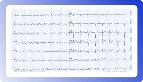 Hyperacute T Waves A Comprehensive Pattern Exploration