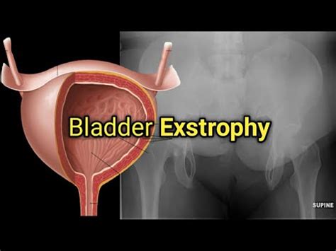 Understanding Bladder Exstrophy In Newborn Youtube