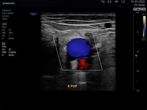 Specular Reflection Ultrasound