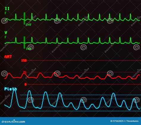Atrial Flutter With Variable Conduction Royalty Free Stock Photography