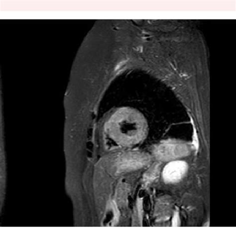Mri T2 Stir Sequences Showing Hyperintensity Of Signal At Download