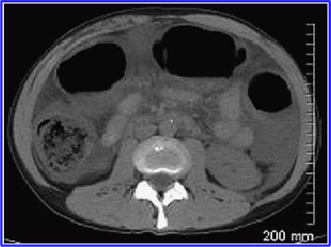 Figure 1 From Surgical Outcome Of Community Acquired Clostridium Difficile Colitis Presenting As