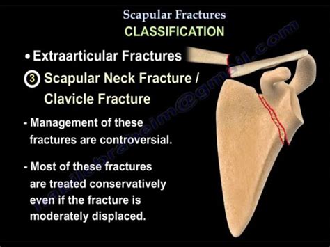 Scapular Fractures Diagnosis And Treatment Plan