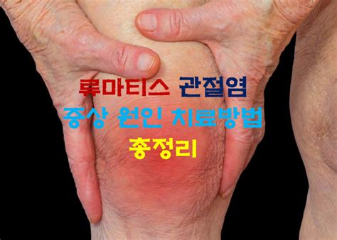 류마티스 관절염 증상 원인 치료방법 총정리
