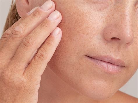 How To Treat Sun Spots On Skin According To An Expert Best Health