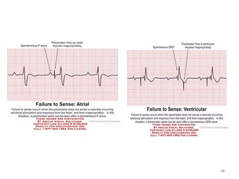 Evaluation And Management Of Pacemaker Malfunction Pptx