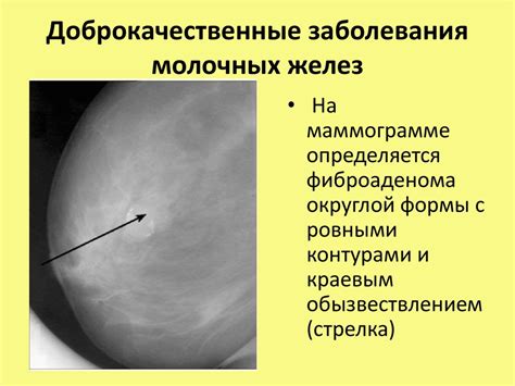 Методы исследования молочных желез женщины - online presentation