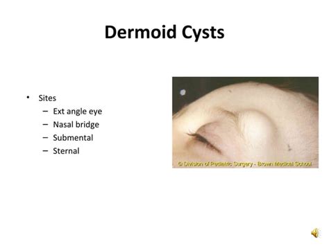 Dermoid And Epidermoid Cysts Ppt
