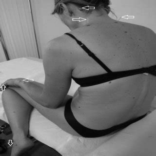 The Figure Indicates The Needles On The Left Side Of The Body Of The Download Scientific