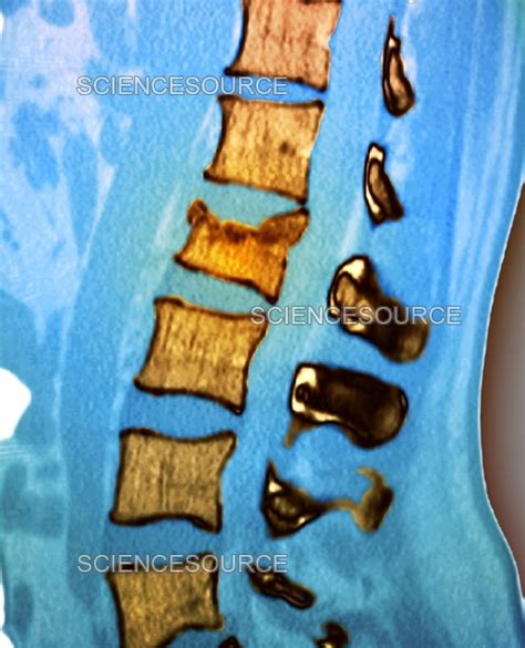Fractured Spine Ct Scan Stock Image Science Source Images