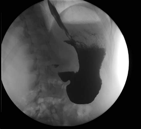 A Markedly Distended Stomach With Proximal Duodenal Dilation Download Scientific Diagram